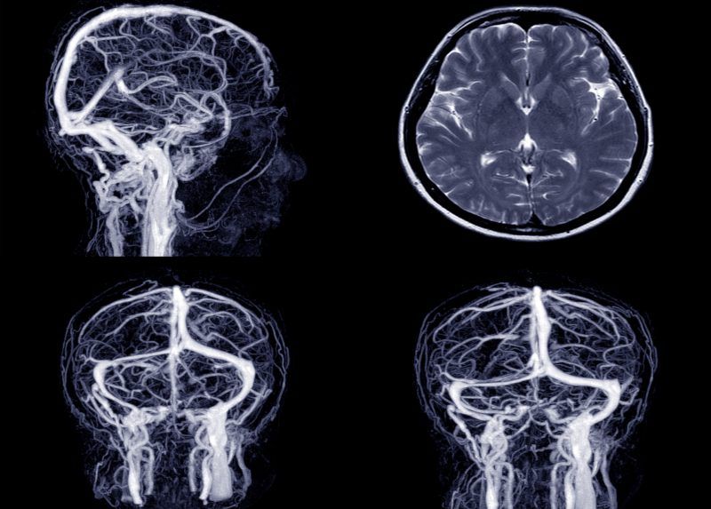 Angioresonancia cerebral - Una radiografía precisa de tu cerebro