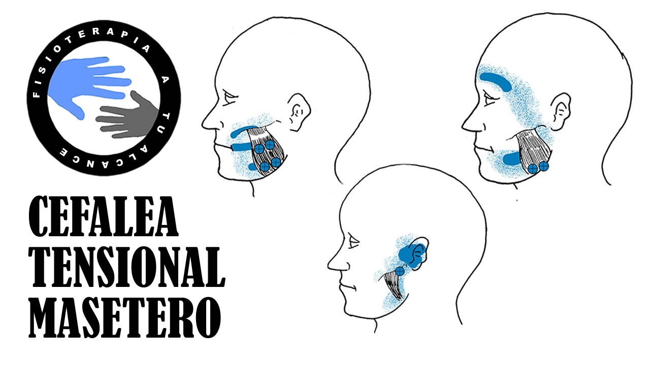 Descubre cómo aliviar el dolor del músculo masetero