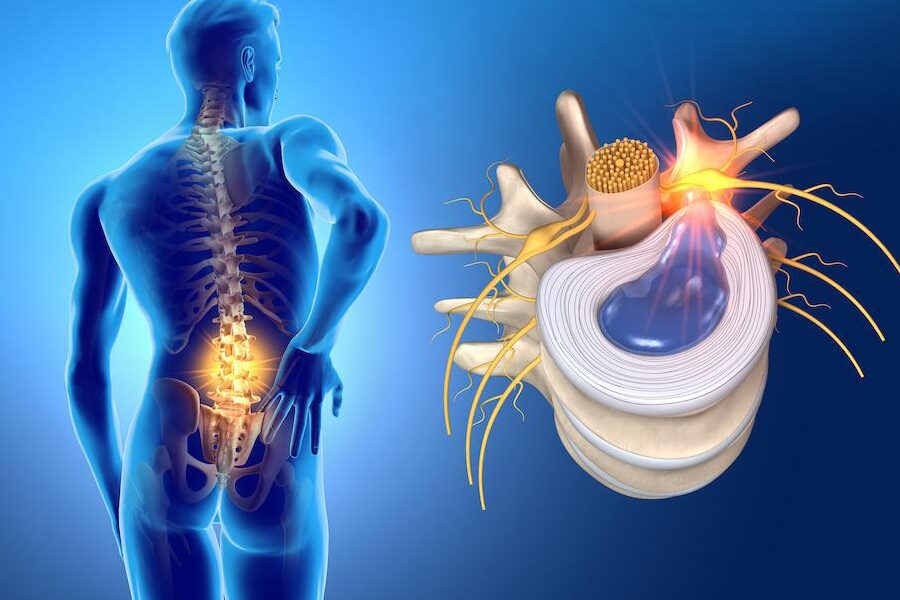 Protrusión Discal: ¿Qué es y Cómo Tratarla?