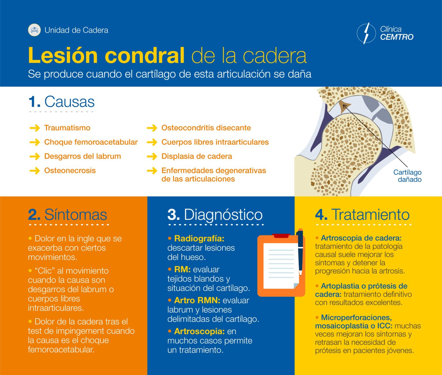 Osteocondritis disecante de cadera: síntomas y causas