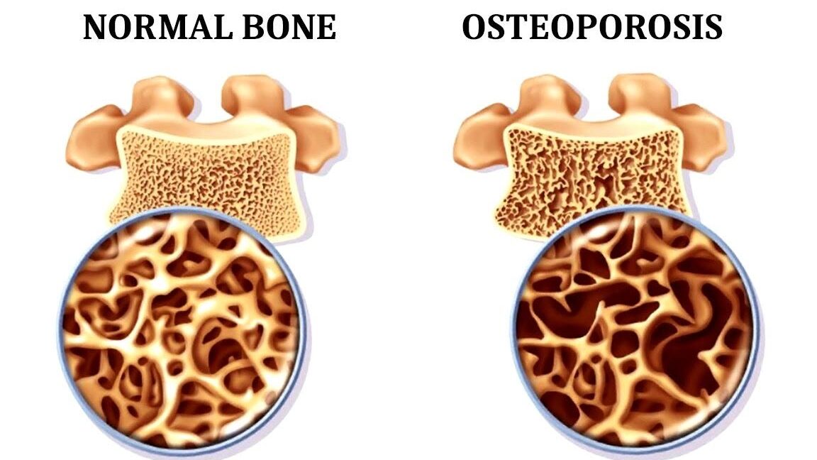 Descubre la diferencia entre Osteoporosis y Osteopenia - Guía Completa
