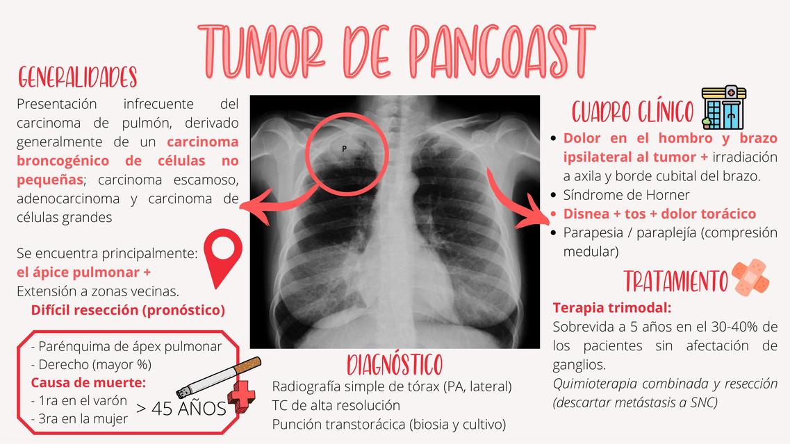 Pancoast tumor: Un enfoque integral sobre el Síndrome de Pancoast en el ...