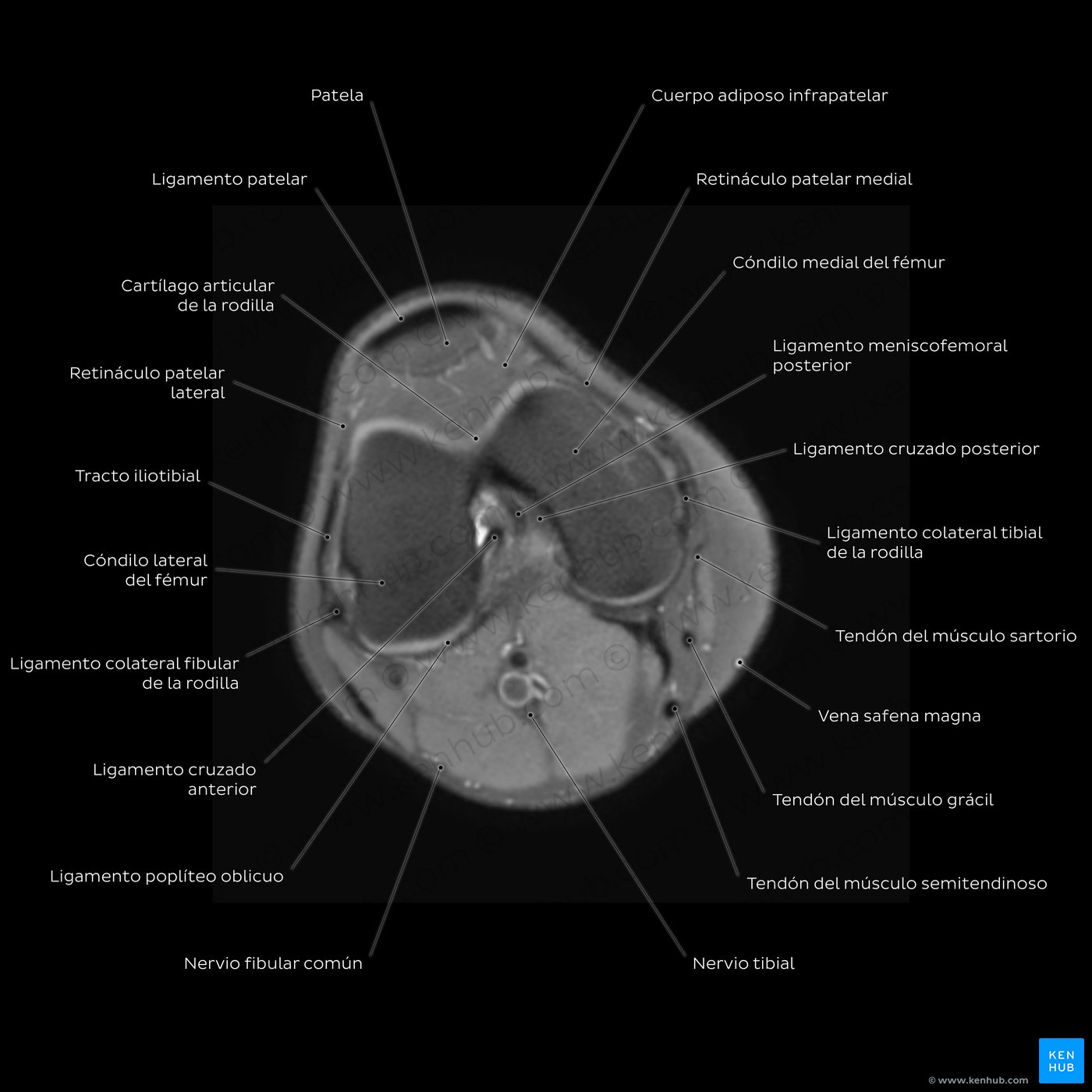 Resonancia de rodilla normal: descubre su importancia